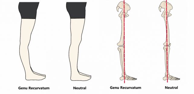 Back knee(반장슬, 전반슬) = Genu recurvatum : 네이버 블로그
