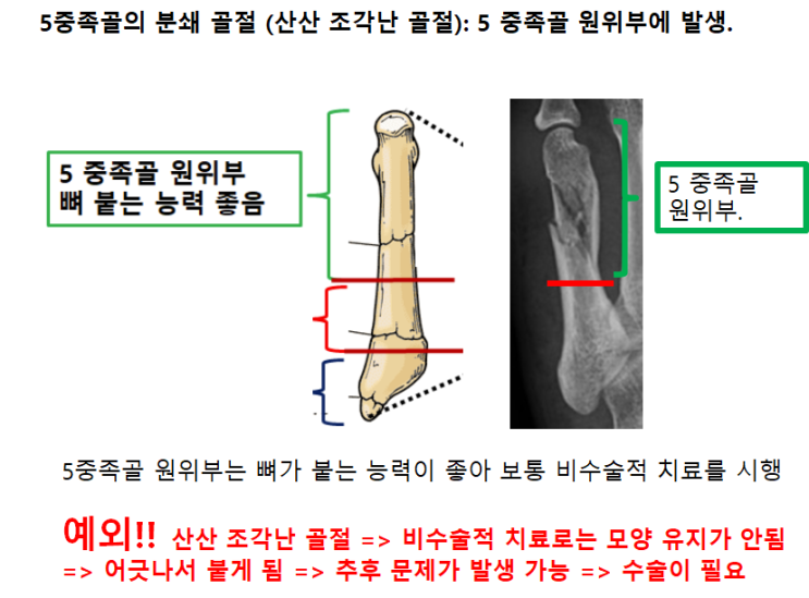 제 5 중족골의 분쇄 골절 수술적 치료 실제 사례 발의 바깥날 뼈가 여러조각나서 부러졌는데 수술이 되나요 분쇄골절 핀