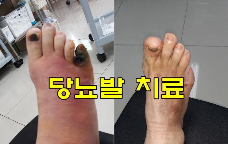 당뇨발을 의심하라 내가 당뇨 설마 내가 당뇨발 고압산소치료 잠수병 당뇨합병증 버거씨병 화상 가스중독 혈액순환