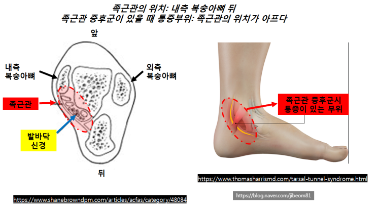 족근관 증후군의 치료 실제 사례 발목 내측이 아파요 발목 내측을 누르거나 만지면 발 바닥까지 쩌릿해요 발목 터널 결절종