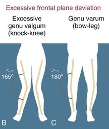 무릎(knee)과 하퇴(lower leg)의 재활- 무릎의 비정상적 정렬(abnormal alignment of knee ...
