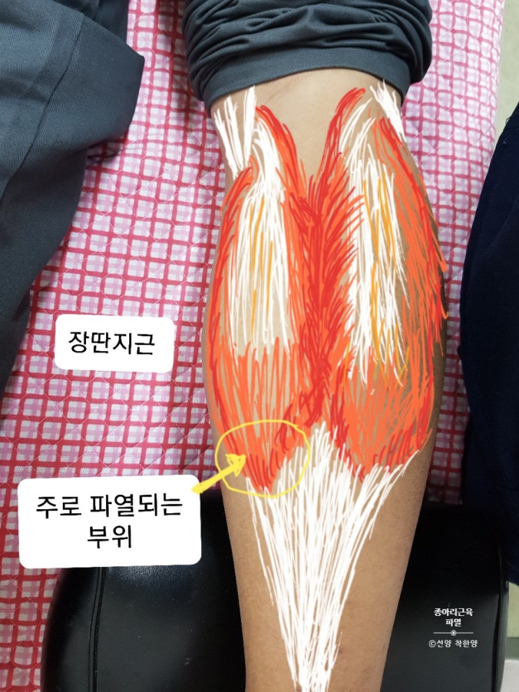 종아리 근육 파열 증상 및 치료 돌멩이 맞은 것처럼 뚝 소리가 나면서 아파요 네이버 블로그
