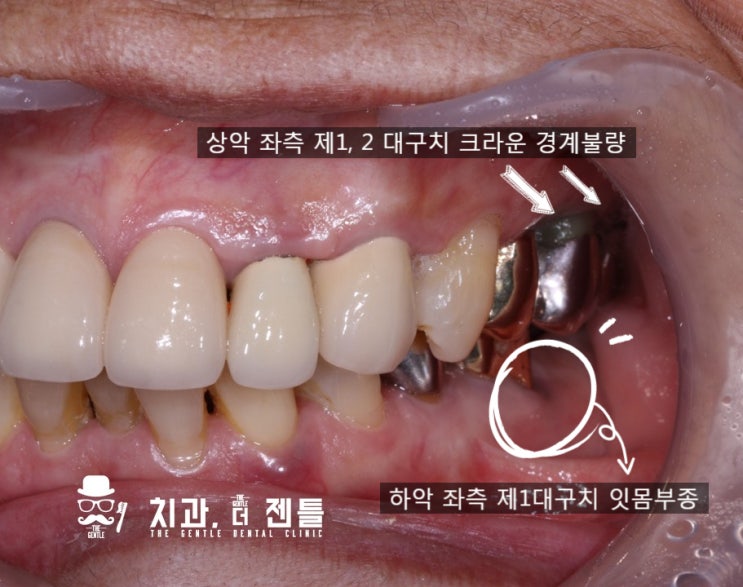 문정동치과문정동임플란트 신경치료 후 염증 재발로 인한 발치 당일 임플란트 식립 증례 골다공증 약 복용 환자에서의 임플란트