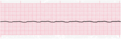 [ACLS]Asystole과 PEA의 정의 : 네이버 블로그