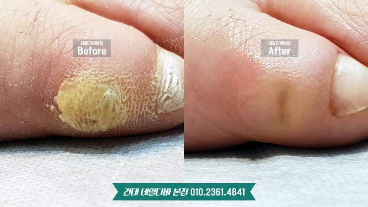 티눈 제거 후기 발가락 티눈이 말끔해졌어요 네이버 블로그