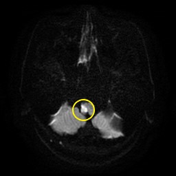 Wallenberg syndrome(lateral medullary infarction, 외측연수경색) : 네이버 블로그