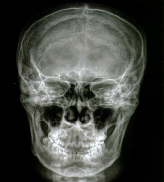 skull PA , skull lateral projection : 네이버 블로그