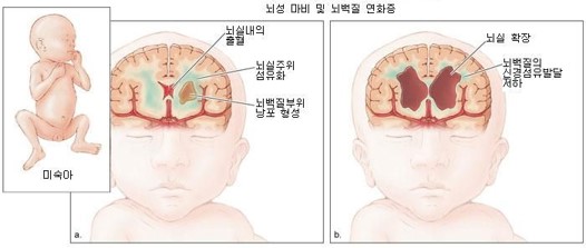 뇌실주위 백질연화증 물리치료 운동치료 감각통합작업치료 언어치료 동탄 레하브레인 아동발달센터 네이버 블로그