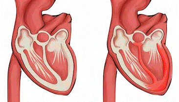 심근염 (Myocarditis) : 네이버 블로그