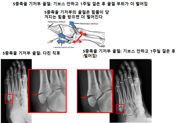 5중족골 기저부 골절의 비수술적 치료 사례 5중족골 기저부 골절 부위가 벌어져도 잘 붙을 수 있나요 힘줄이 당긴다는데 잘
