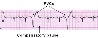 이상 심전도 - 심실조기수축(premature ventricular contraction, PVC) : 네이버 블로그