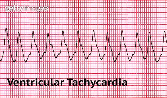 이상 심전도 - 심실빈맥(ventricular tachycardia, VT) : 네이버 블로그