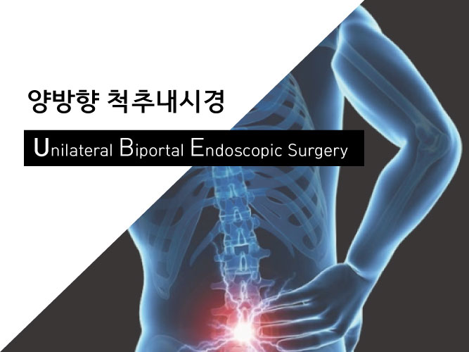 지속되는 허리통증, 양방향 척추 내시경으로 UBE(Unilateral Bi-portal Endoscopie surgery ...