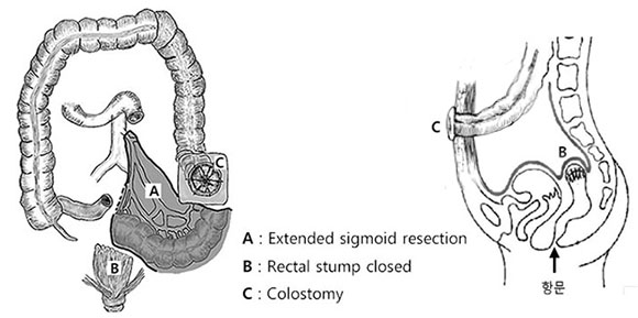 하트만 술식(Hartmann's procedure) : 네이버 블로그