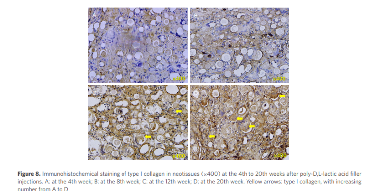 PLA (Polylactic acid), PLLA/PDLLA,스컬트라, 레시나, 주베룩에 대하여 (2) 제품 : 네이버 블로그