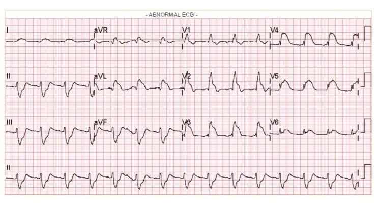 이제 ECG 공부는 그만 (1) : 네이버 블로그