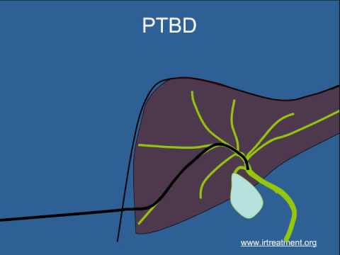 PTBD vs T-tube : 네이버 블로그