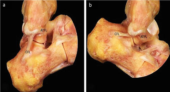 발목 불안정성에서 CFL(종비인대)의 역할 (Role of CFL injury in Ankle instability) : 네이버 블로그
