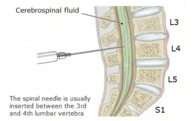 Spinal tapping(=lumbar puncture, 요추천자) : 네이버 블로그