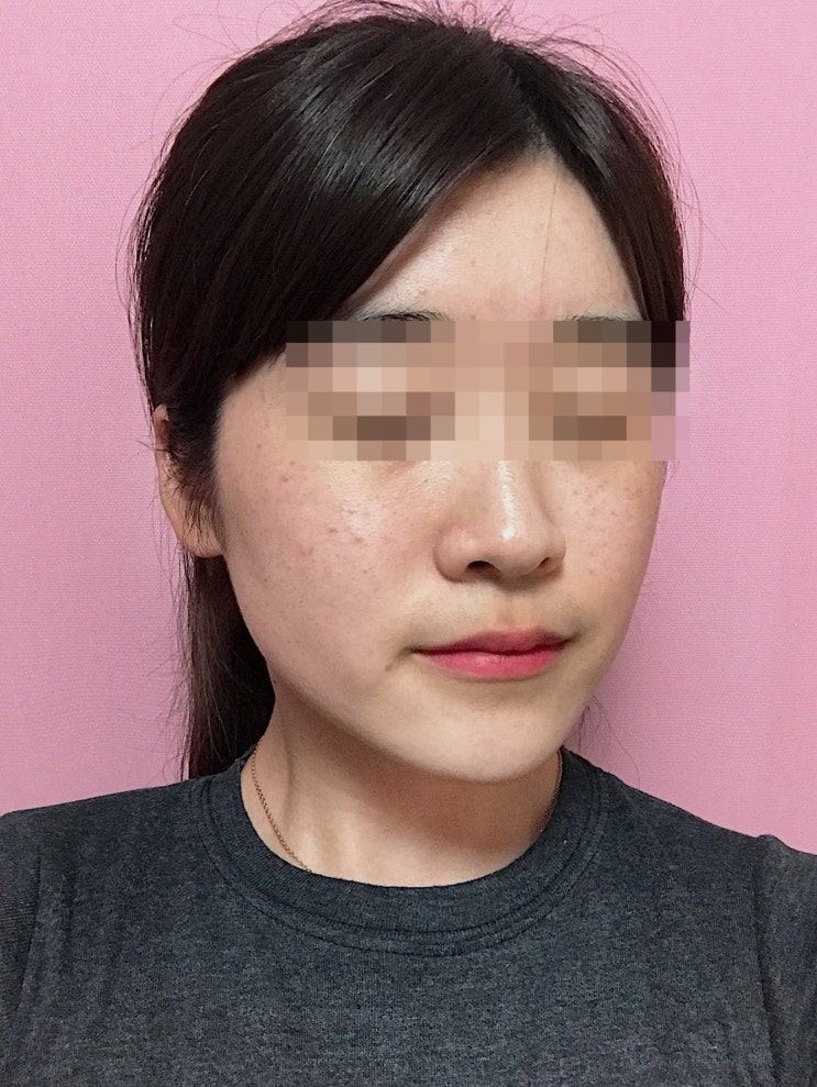 루비레이저후기 색소치료 5회차 시술까지 받은 전후사진 네이버 블로그