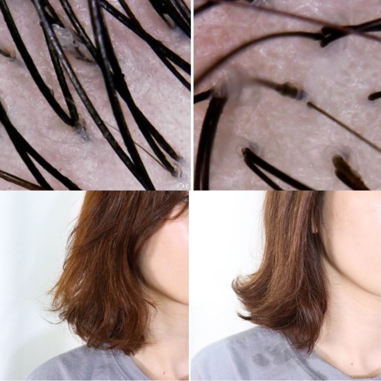 두피 각질 샴푸 건조한 계절 필수템으로 머리비듬없애는법 네이버 블로그