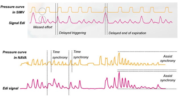 NAVA mode for Servo-n ventilator (핵심) : 네이버 블로그