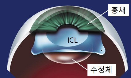 안내 시술 렌즈 IOL과 ICL의 차이(by 약사 정비환) : 네이버 블로그