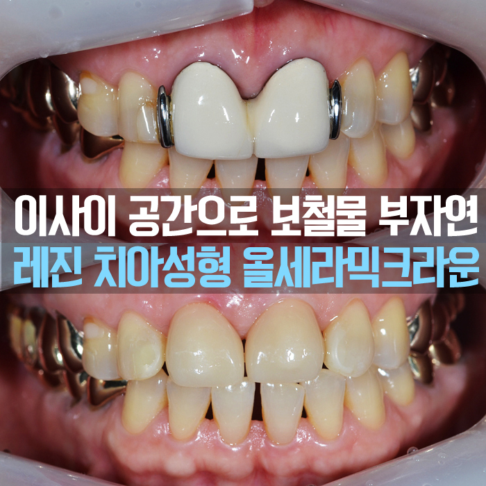 대구 치료 잘하는 치과 E28치과 앞니사이 벌어짐 공간 레진변색 부자연스러운 앞니보철 레진으로 치아성형 올세라믹