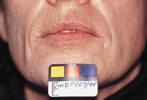입가주름 레이저치료, 박피술의 효과는? perioral wrinkles, laser dermabrasion : 네이버 블로그