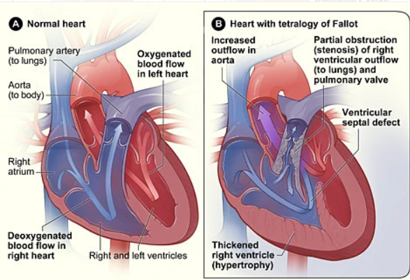 팔로 4징후 (tetralogy of Fallot) 허파동맥 협착증/ 심실 사이막 결손/ 대동맥 기승(overriding ...