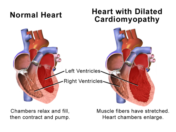 DCM(Dilated Cardiomyopathy;확장성 심근병),PDA(Patent ductus arteriosis;동맥관 ...