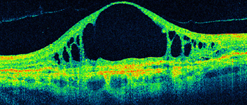 망막질환 정리 - 유의한 황반 부종 (Clinically Significant Macular Edema) CSME : 네이버 블로그