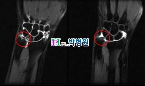 울산 박철 정형외과 - 삼각섬유연골복합체(triangular fibrocartilage complex, TFCC)이란 ...