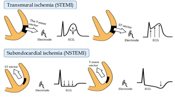 심전도의 해석2 (STEMI, NSTEMI) : 네이버 블로그