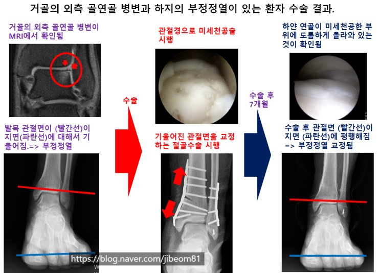거골의 골연골 병변의 실제 수술적 치료 사례 다친 후에 발목 외측이 지속적으로 아파요 연골이 손상 되었다고 하는데요 족부