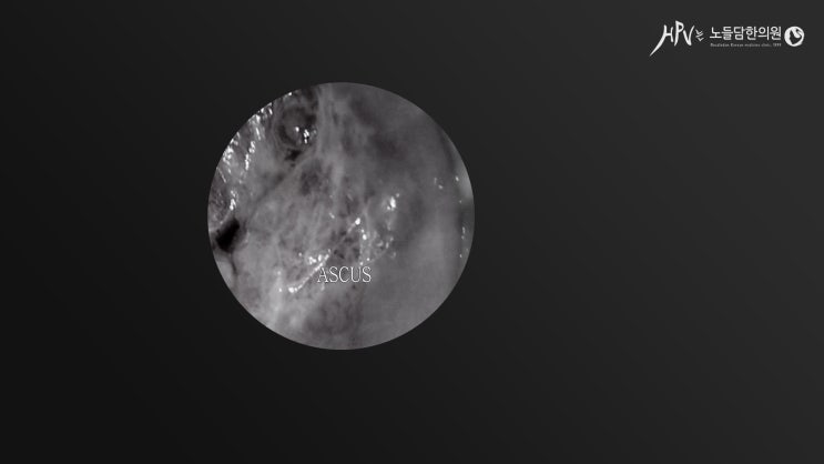 ascus(아스쿠스, ASC-US) 진단 몇 개월 후 호전될 수 있을까 : 네이버 블로그