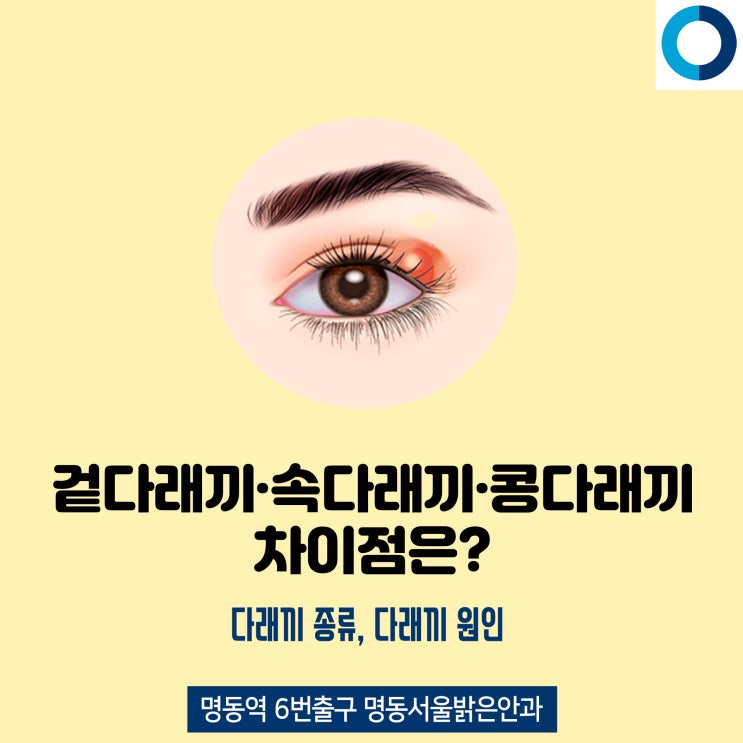 다래끼 원인 증상 치료 예방 다래끼 종류 겉다래끼 속다래끼 콩다래끼 네이버 블로그