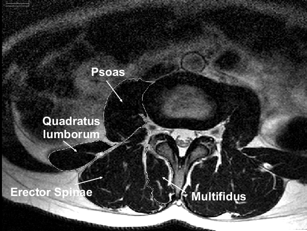 MRI를 통하여 살펴보는 요추의 해부학적 구조 - Transverse plane : 네이버 블로그