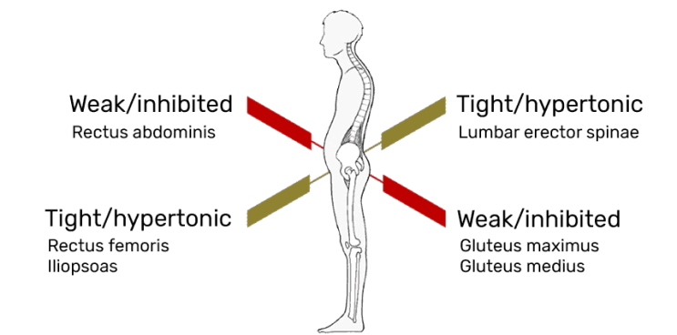 골반(pelvic)과 엉덩관절(hip joint)의 재활- 짝힘(force- couple)과 하지교차증후군(lower ...