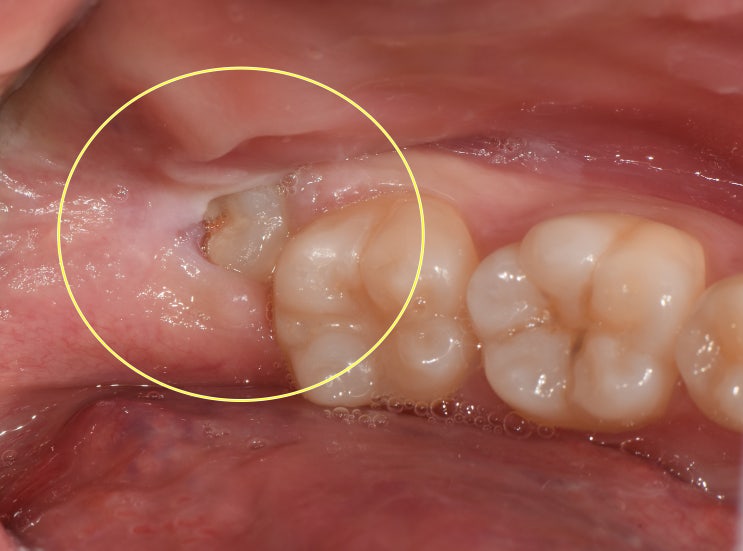 똑바로 서있는 수직 매복 사랑니 발치 - 하치조신경관과 가까운 아래 사랑니(주의 :발치사진포함) - 수원우리사랑치과 : 네이버 블로그