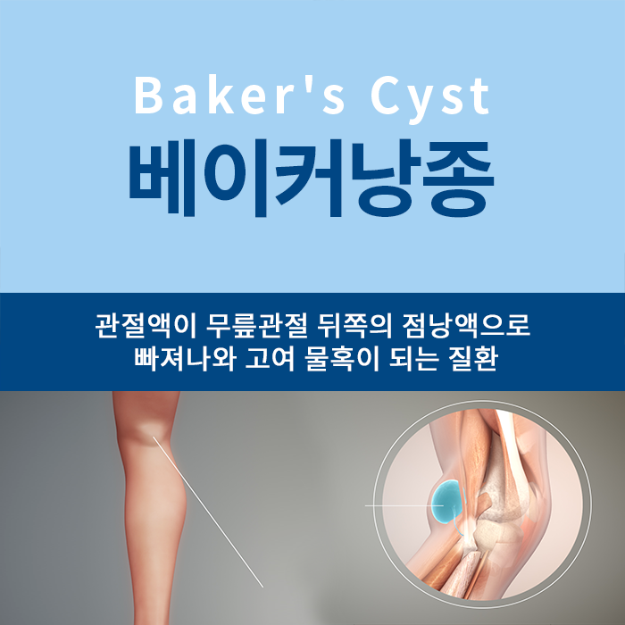 무릎 뒤 통증 유발하는 물혹 베이커낭종 Bakers Cyst 네이버 블로그