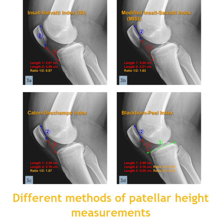 농구와 배구에서 발생되는 슬개뼈 힘줄염(Patellar Tendinitis)의 원인과 측정 - Patella Alta와 ...