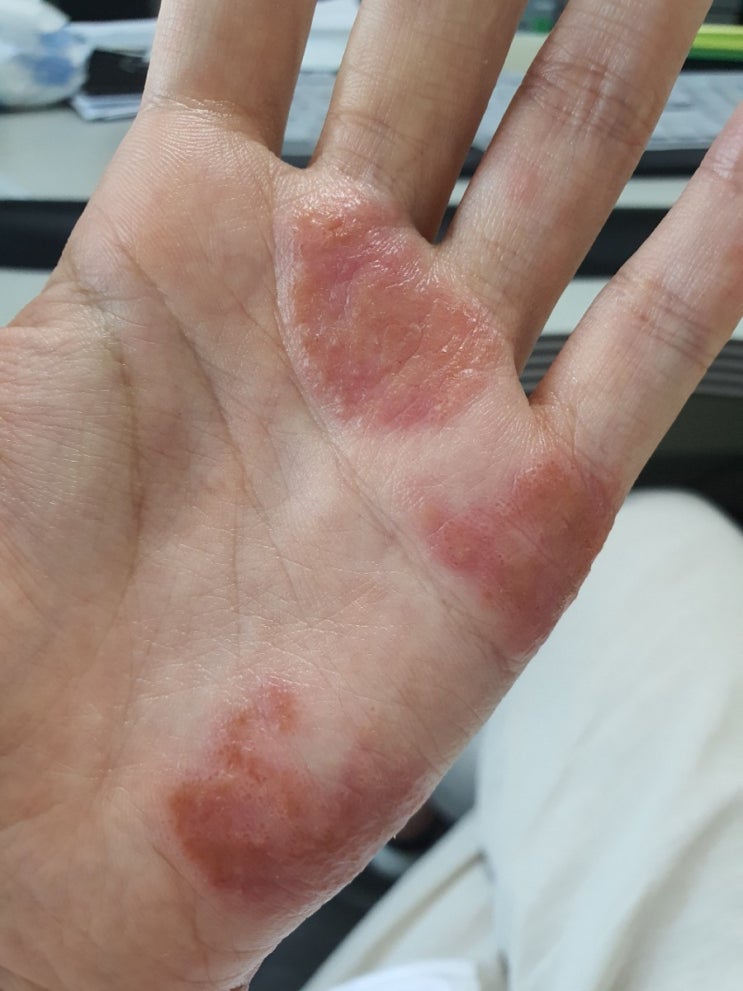 한포진손바닥손가락이겨내기1 수포가려움 물집진물 심하게 날때 네이버 블로그