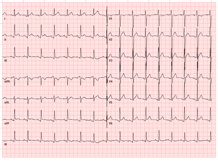 급성심장막염 심전도, Acute pericarditis, ECG : 네이버 블로그