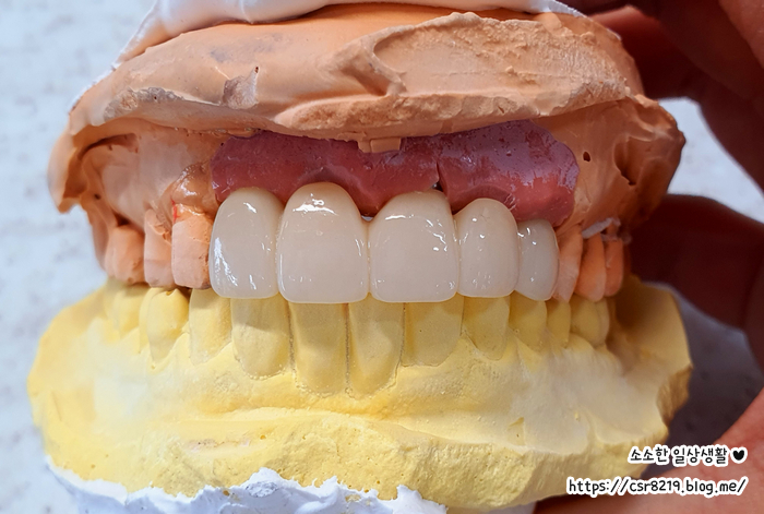 치과기공사의 일상 / 상악 5전치 implant zir crown ( Custom abutment + 지르코니아 ) : 네이버 블로그