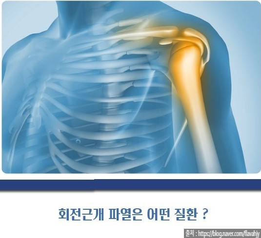 회전근개 파열의 한방치료 어깨가 아파요 네이버 블로그