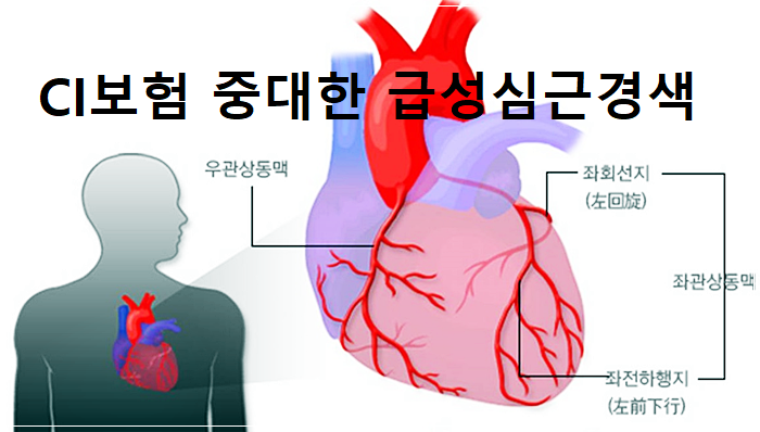 중대한 급성심근경색 진단비는 무엇이 다른가 네이버 블로그