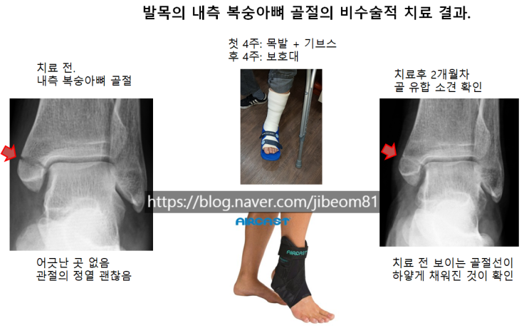 발목 내측 복숭아뼈 골절의 비수술치료 사례 자전거 타다가 넘어졌는데 그 이후 발목 내측 복숭아뼈가 아파요 족부 정형외과