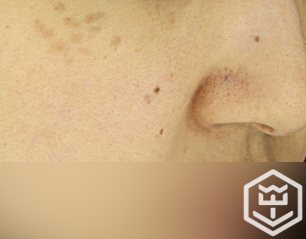 유성피부과, ABNOM(후천성오타양모반) 치료하기 : 네이버 블로그