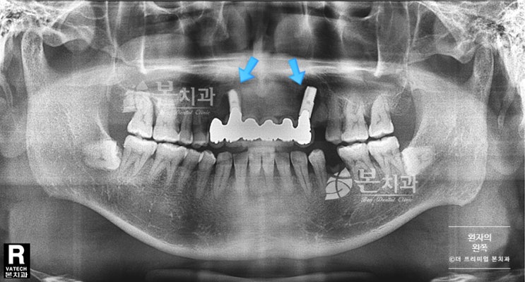 임플란트 케이스 돌아보기 아산치과더 프리미엄 본 치과의 아산임플란트 케이스 타치과에서 실패한 임플란트 복원하기 네이버 블로그